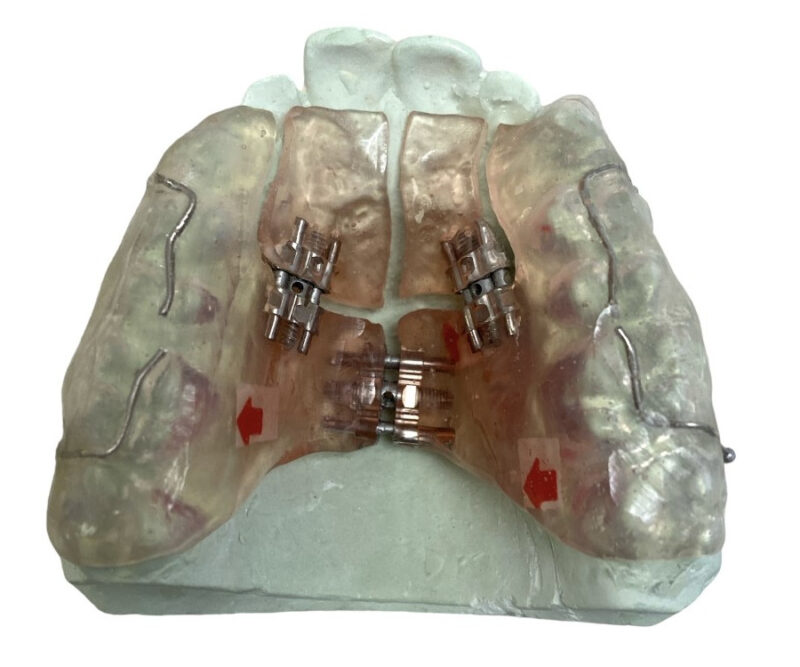 Airway Orthodontics – Praska Orthodontics